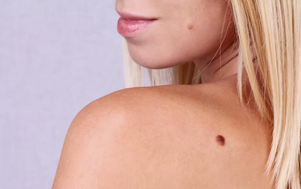 Chemical Peels and Moles | Short Hills Dermatology