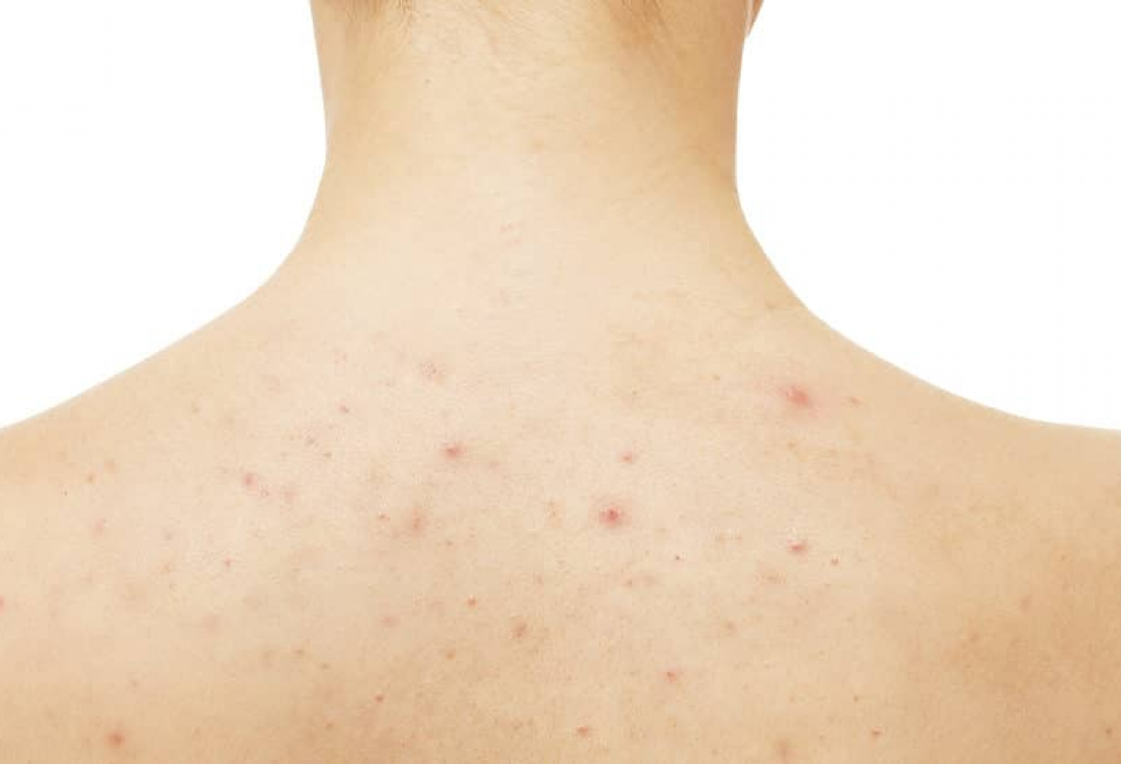 What You Need to Know About Back Acne | Short Hills Dermatology