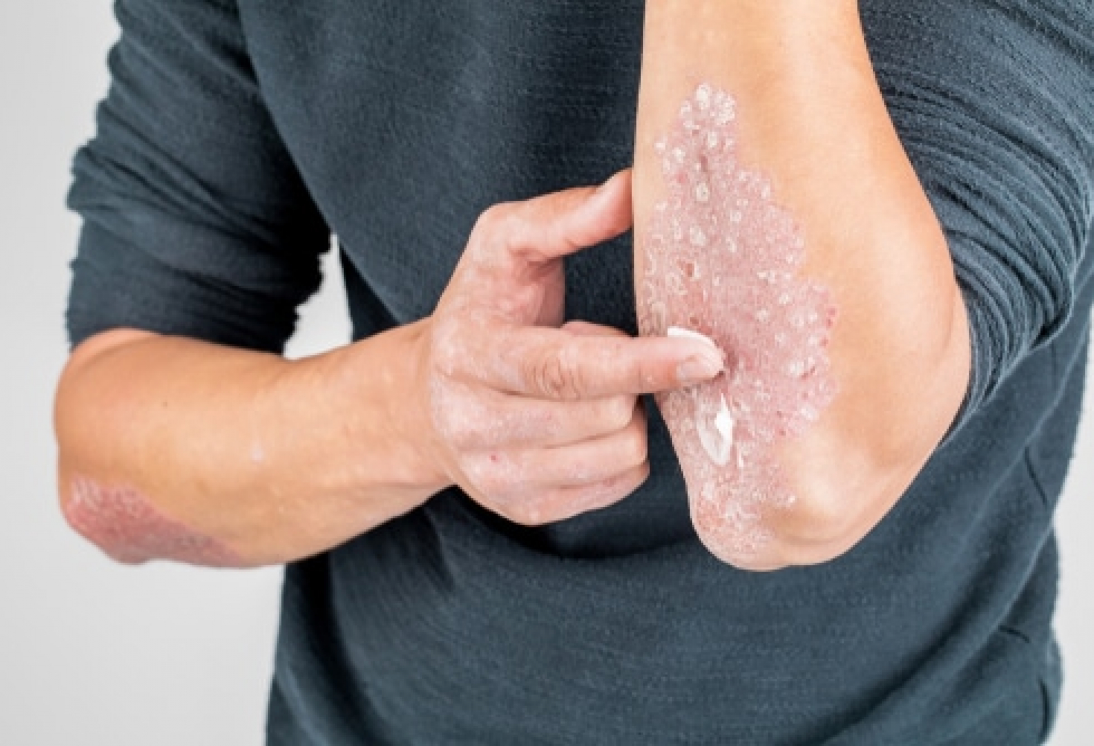 Effective Treatment Options for Psoriasis - Short Hills Dermatology