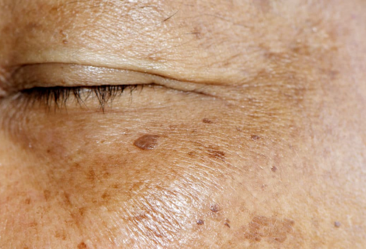 How To Treat Under Eye Bags and Dark Circles | Short Hills Dermatology